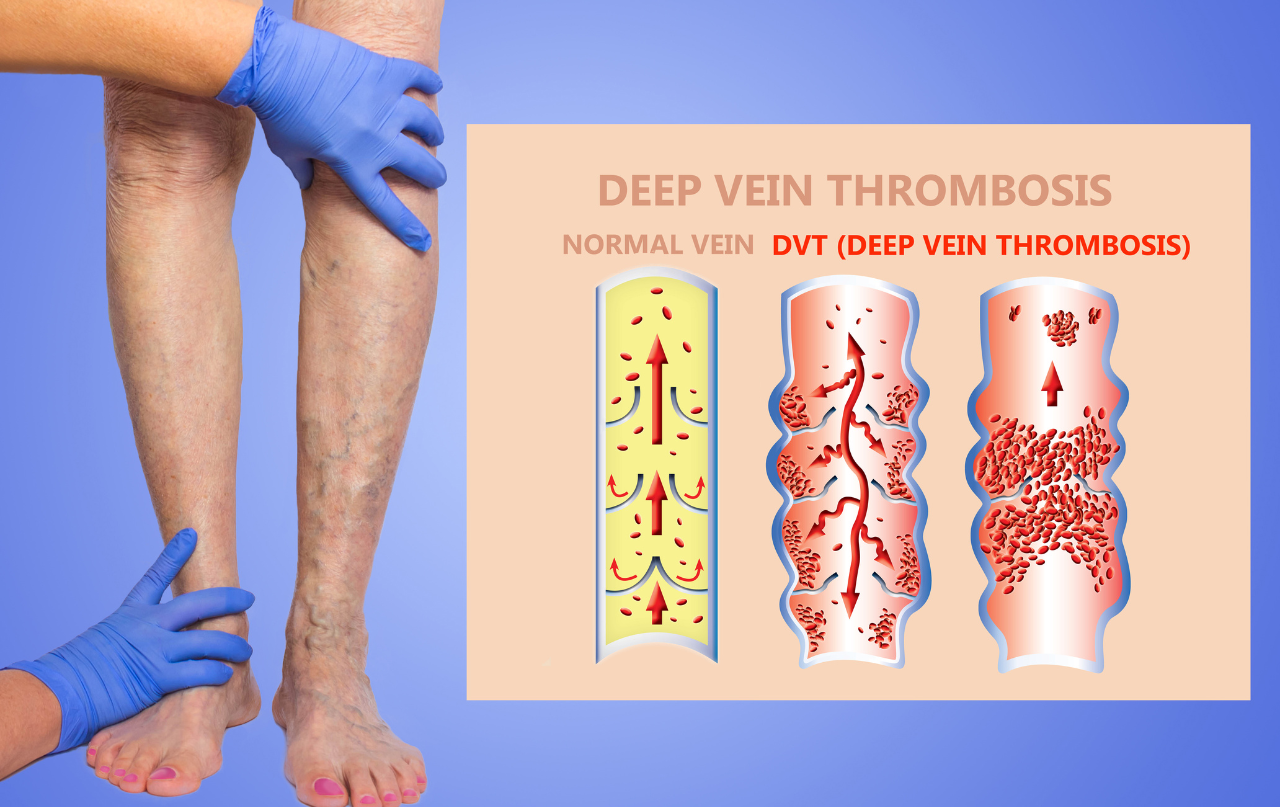 Top 5 Vitamins to Boost Circulation in Legs & Feet